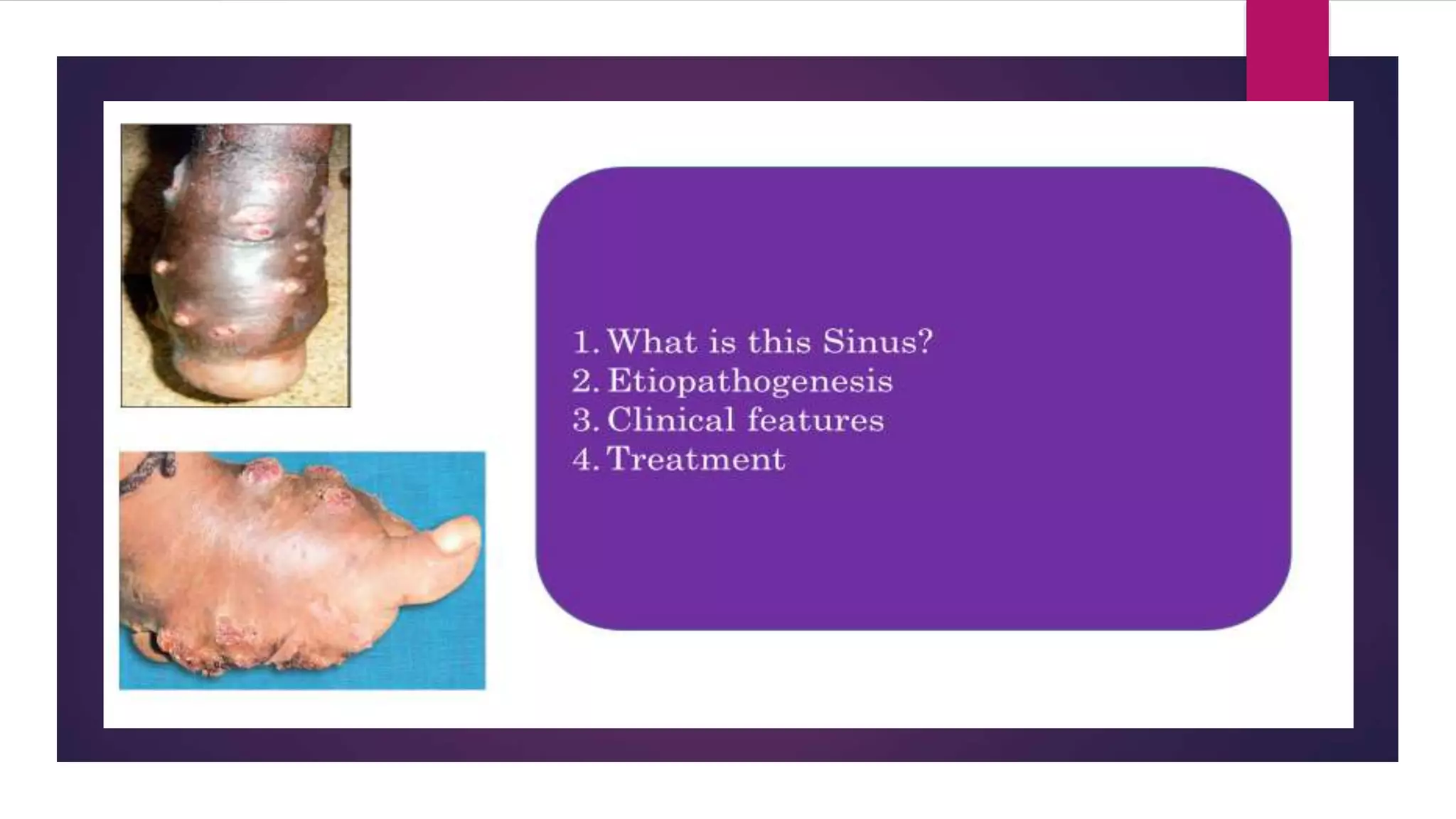 Ulcer, sinus and fistula pbl case scenario triggers | PPTX