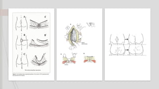 ULCER, SINUS, abscess, fistula vewry basics.pptx