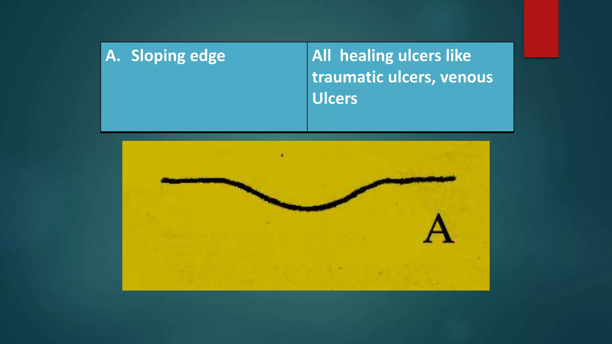 Ulcer sinus fistula | PPTX