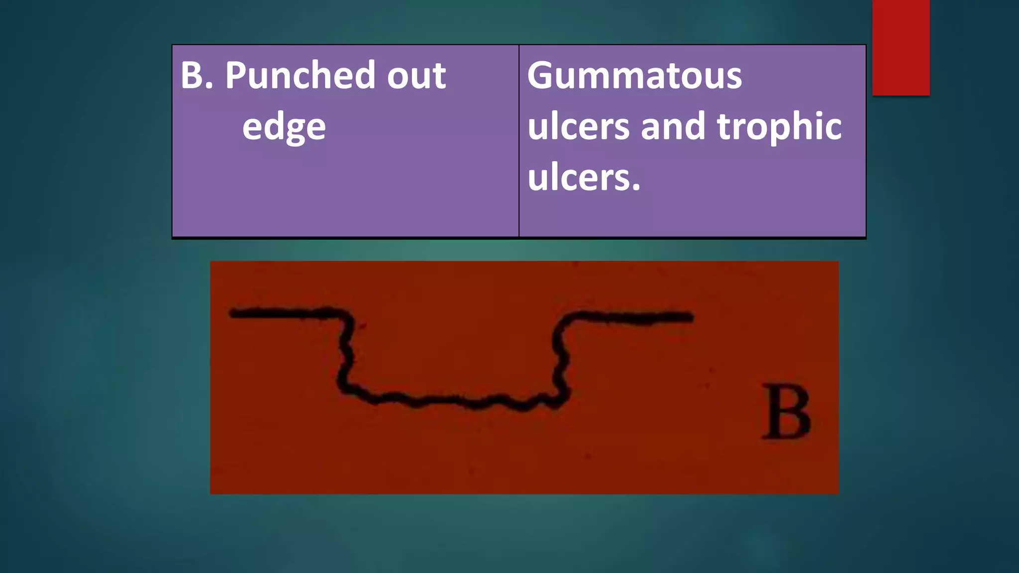Ulcer sinus fistula | PPTX