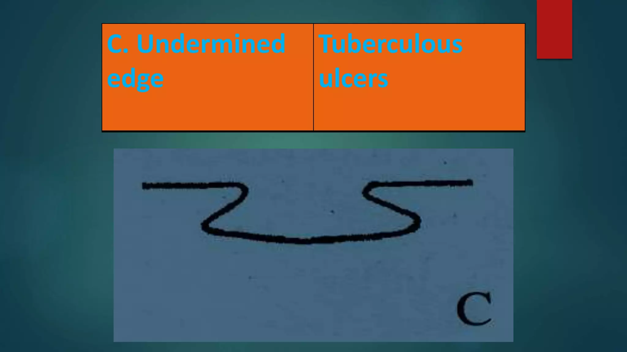 Ulcer sinus fistula | PPTX