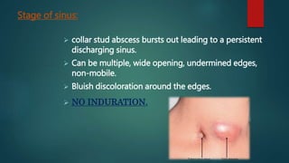 Ulcer sinus fistula | PPTX