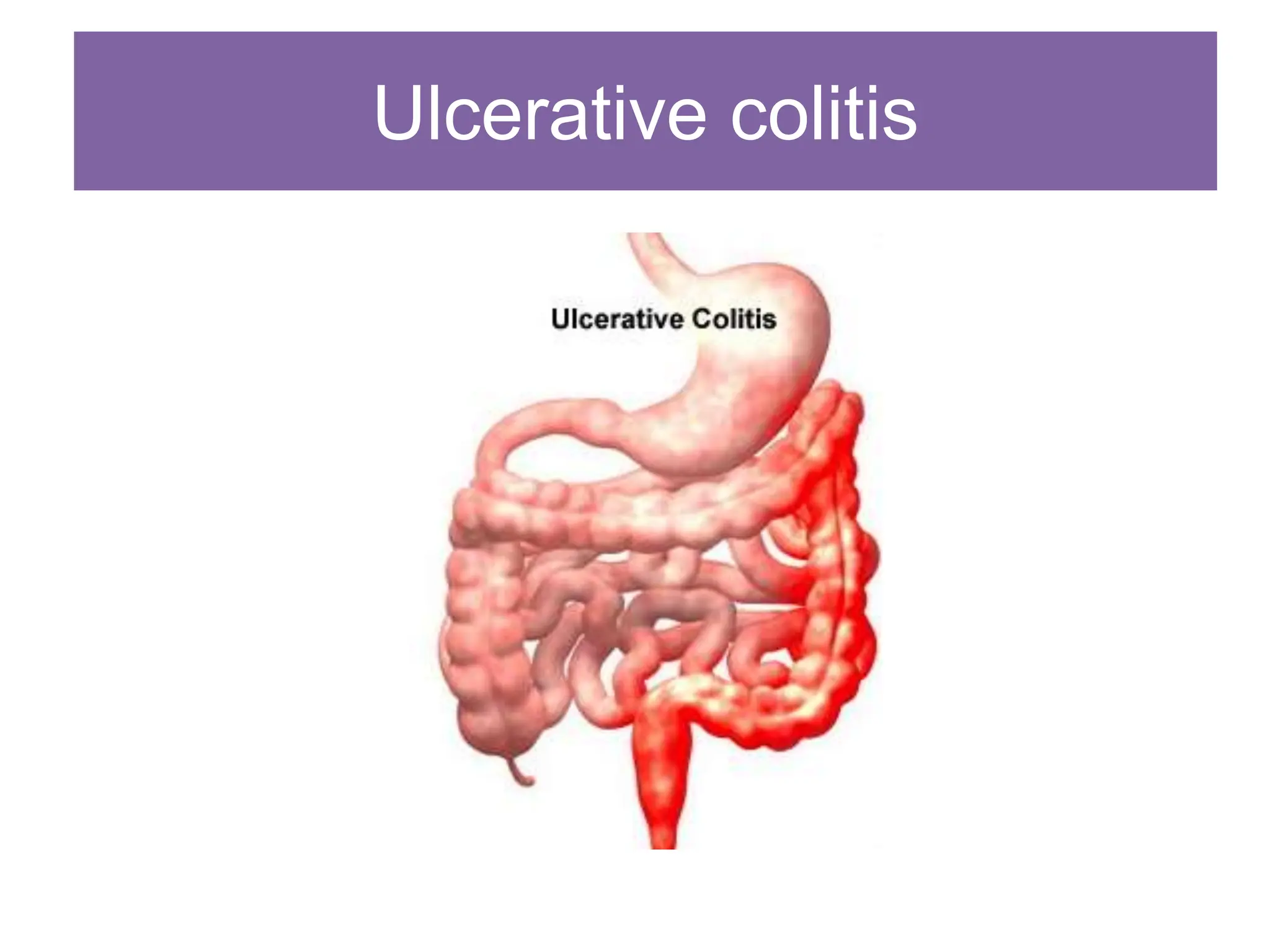ulcersoftheintestinepatjology170305141940.pptx