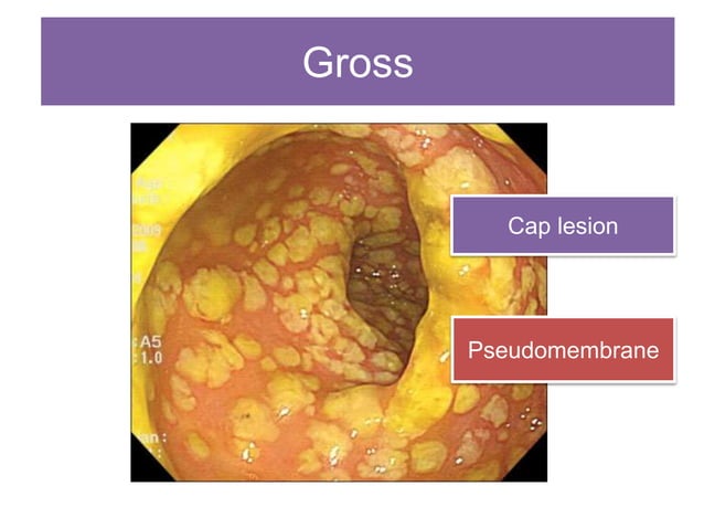 ulcersoftheintestinepatjology170305141940.pptx