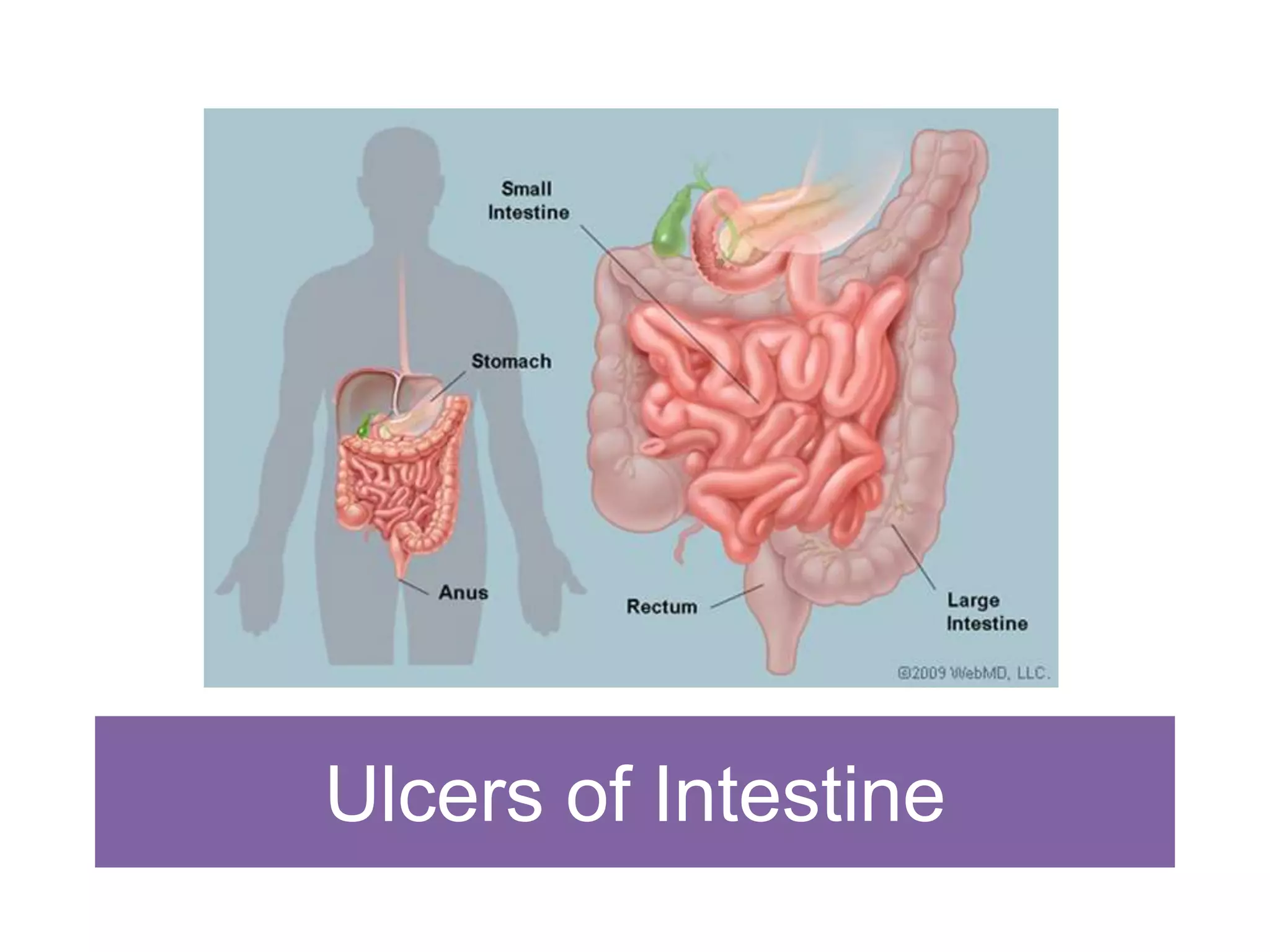 Ulcers of the intestine | PPTX