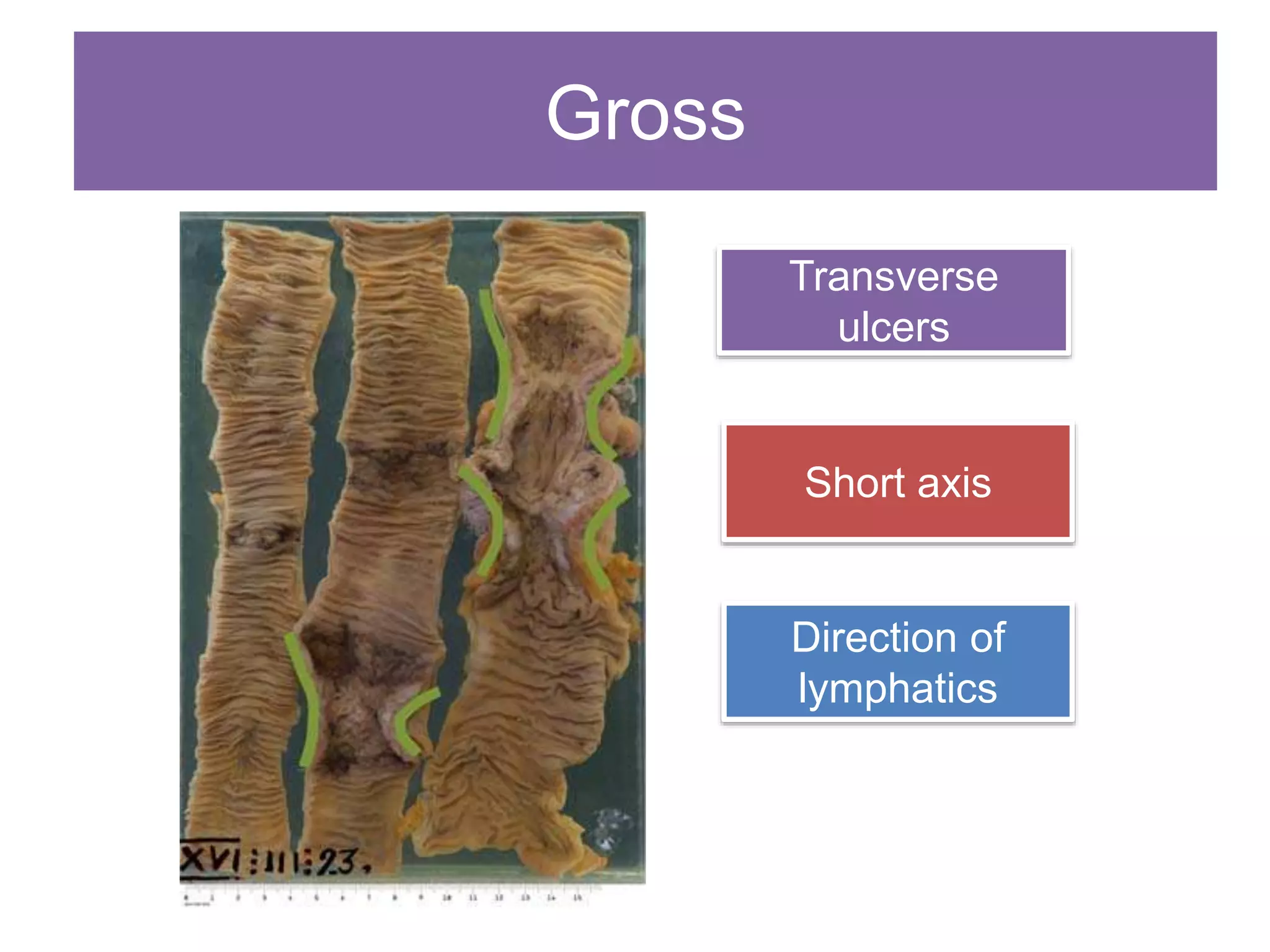 Ulcers of the intestine | PPTX
