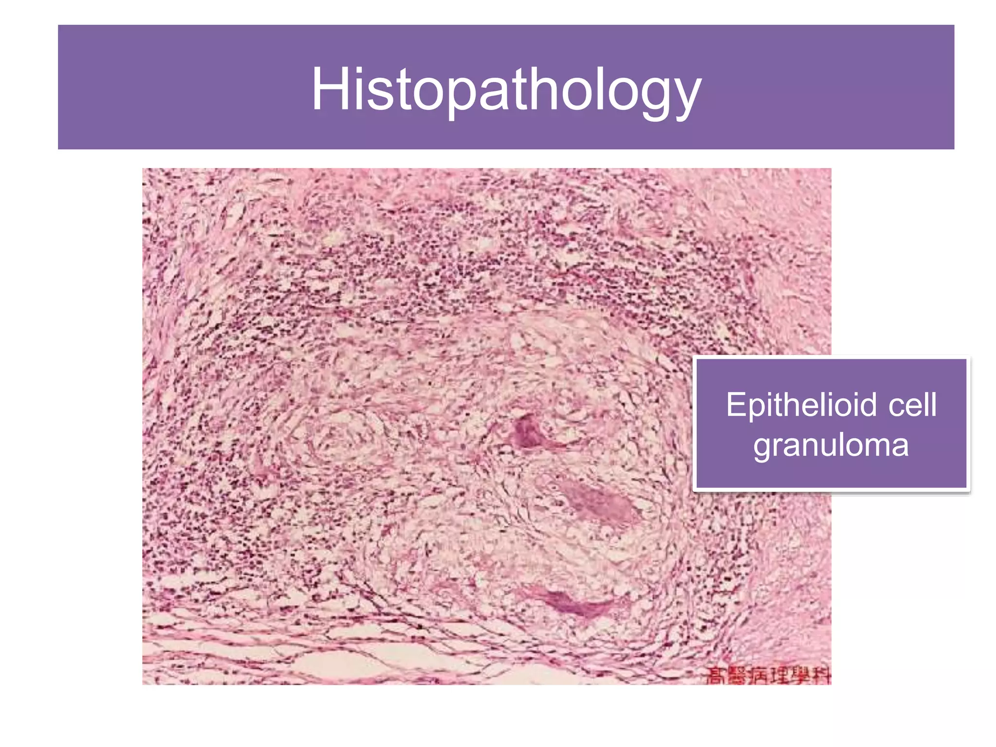 Ulcers of the intestine | PPTX