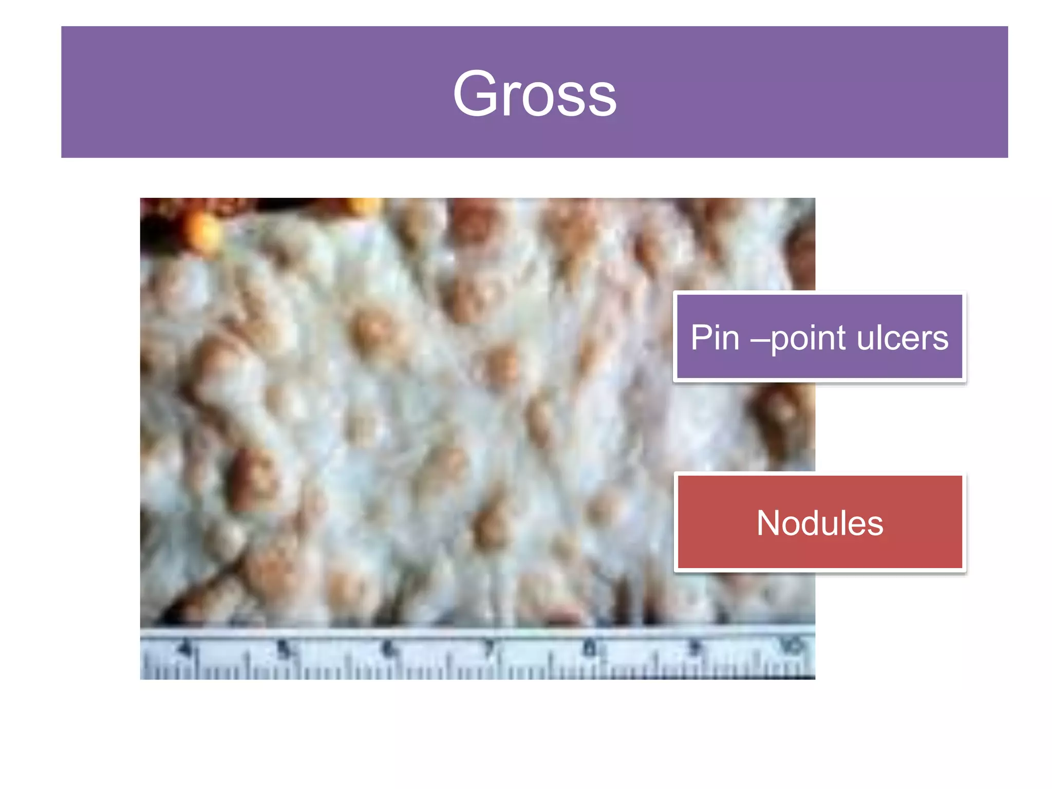 Ulcers of the intestine | PPTX