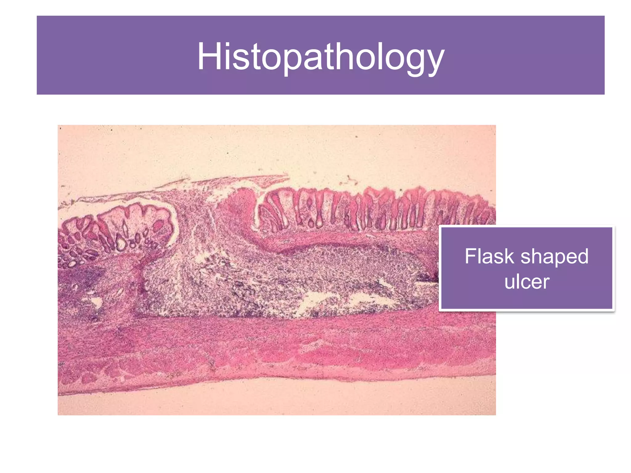 Ulcers of the intestine | PPTX