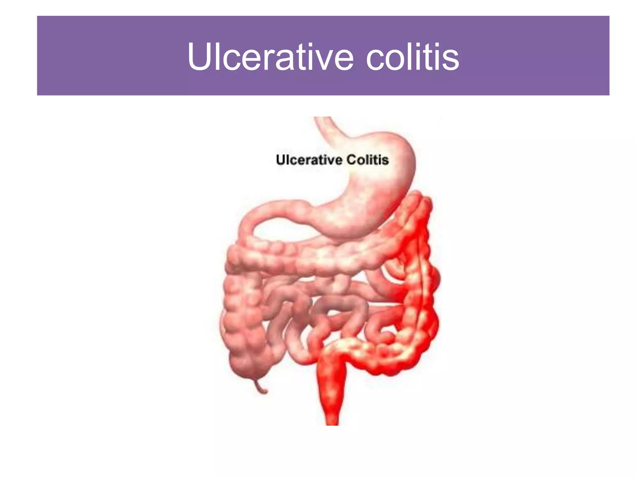 Ulcers of the intestine | PPTX