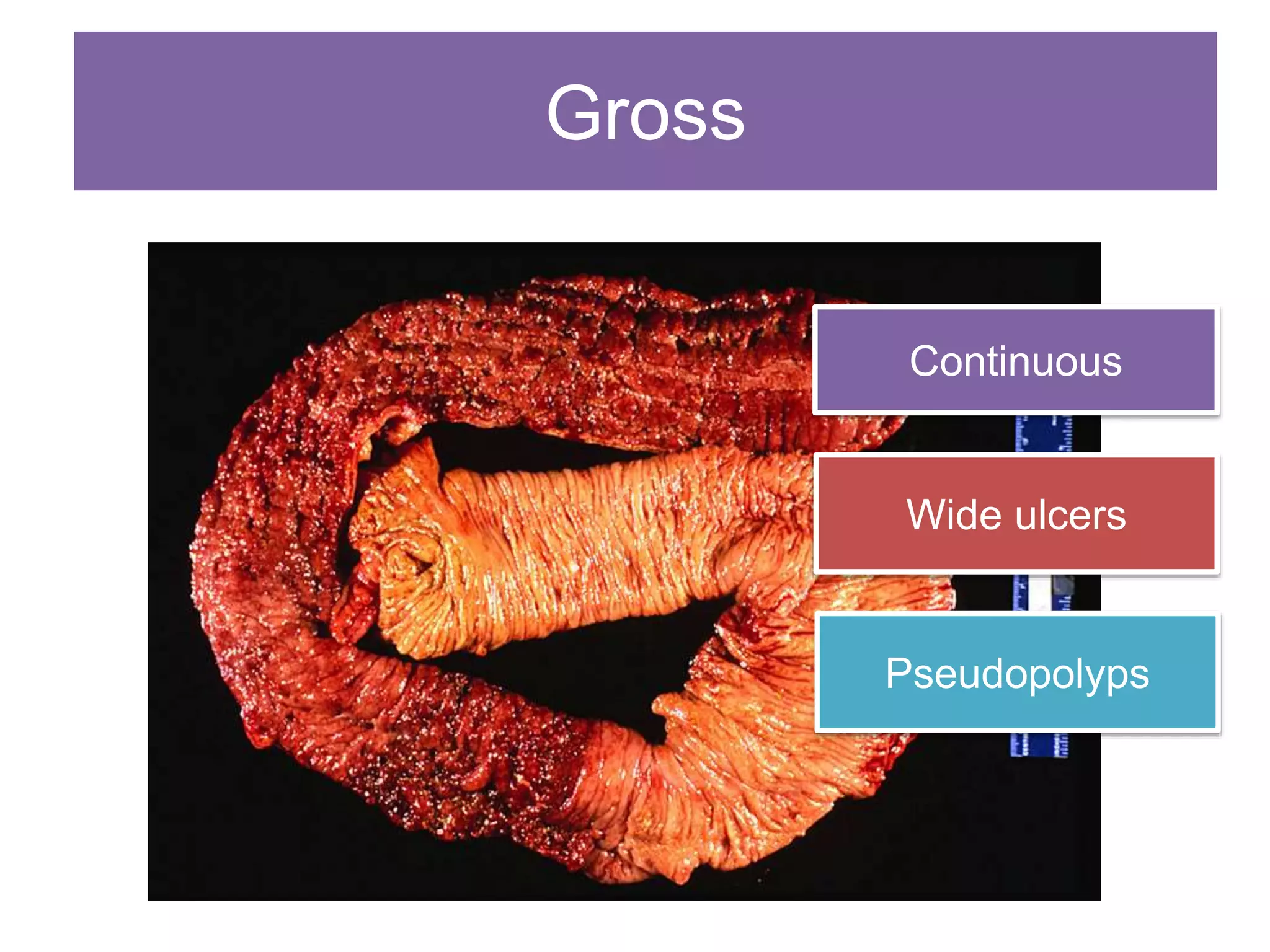 Ulcers of the intestine | PPTX