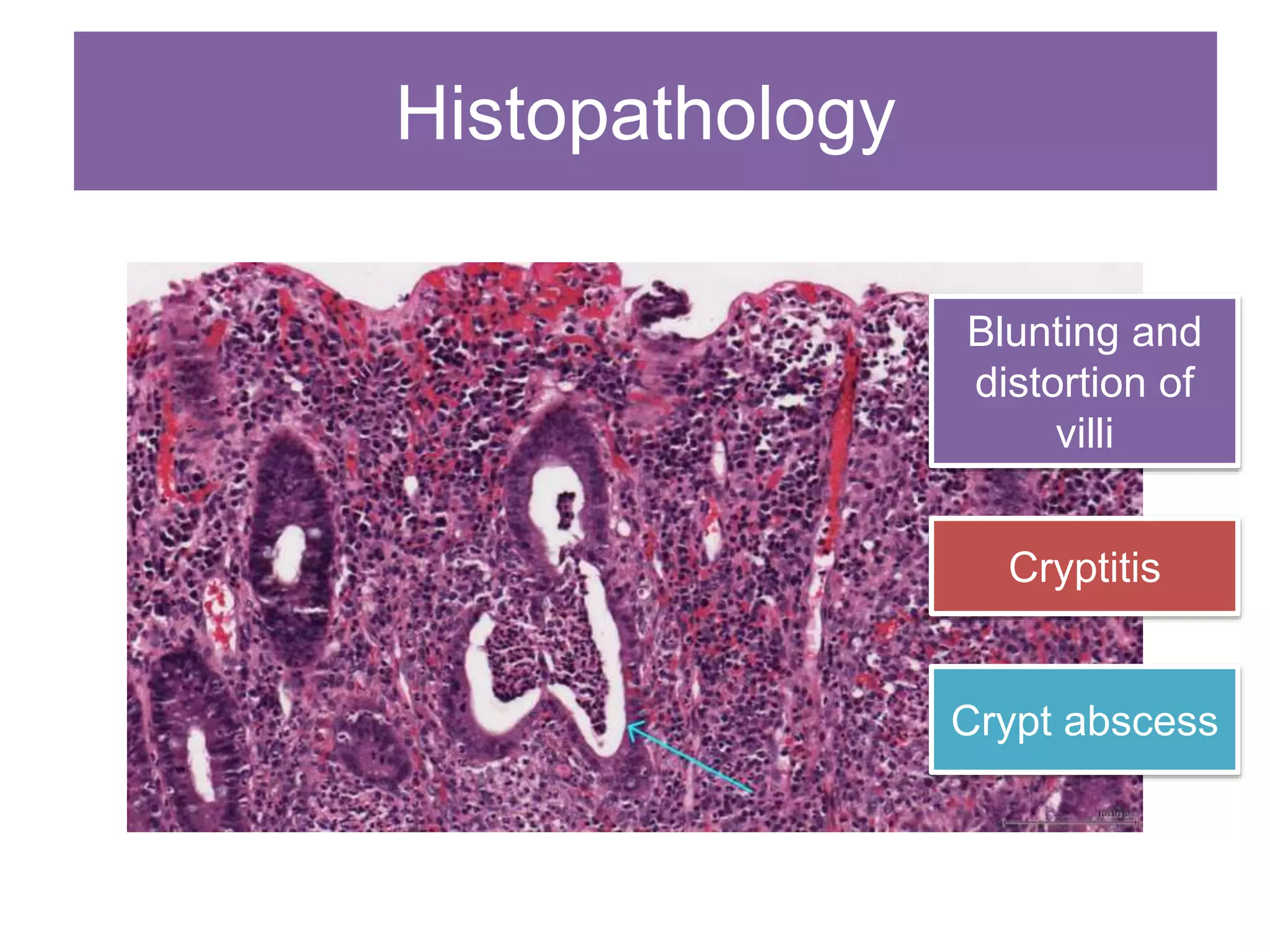 Ulcers of the intestine | PPTX