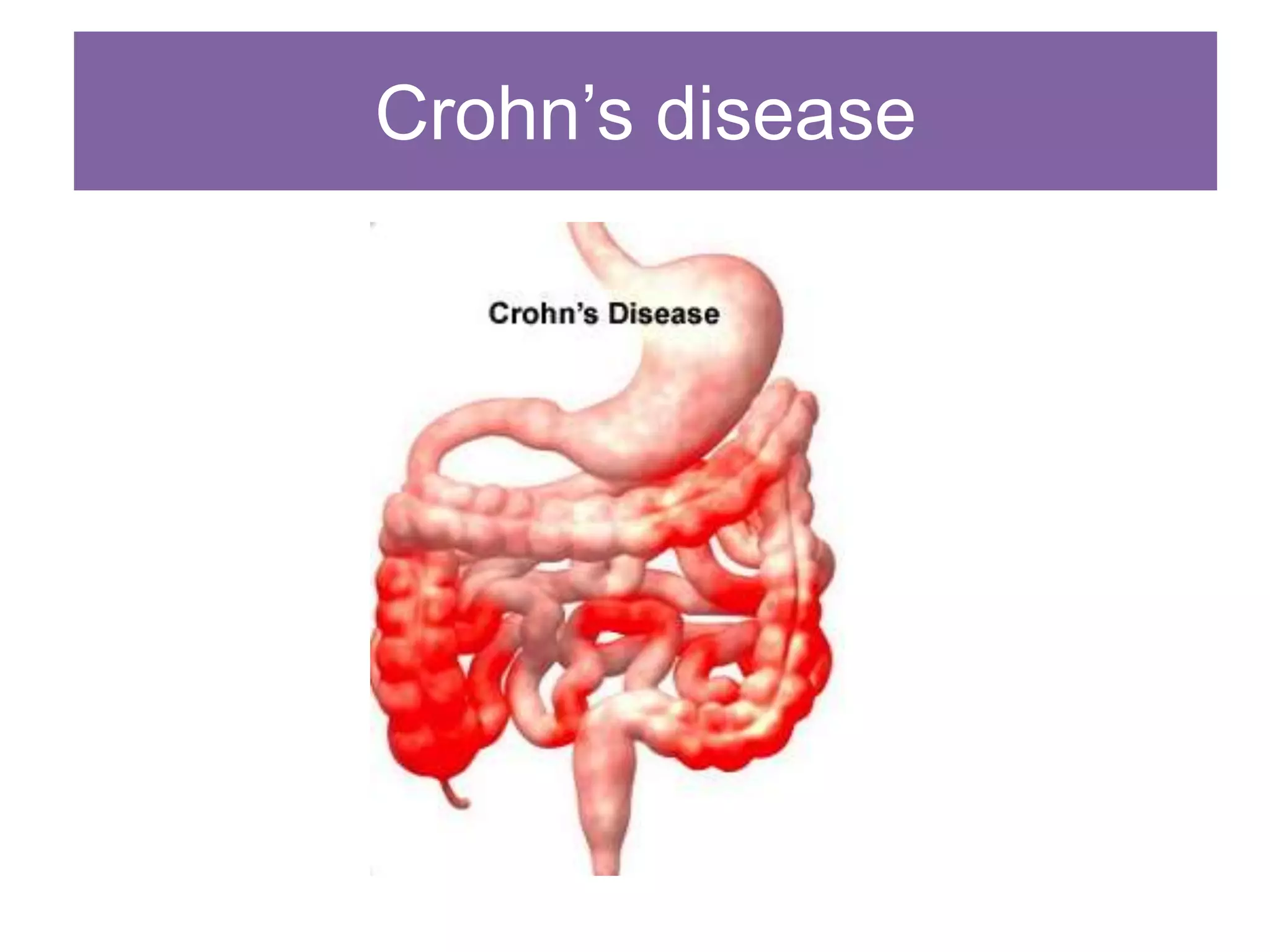 Ulcers of the intestine | PPTX