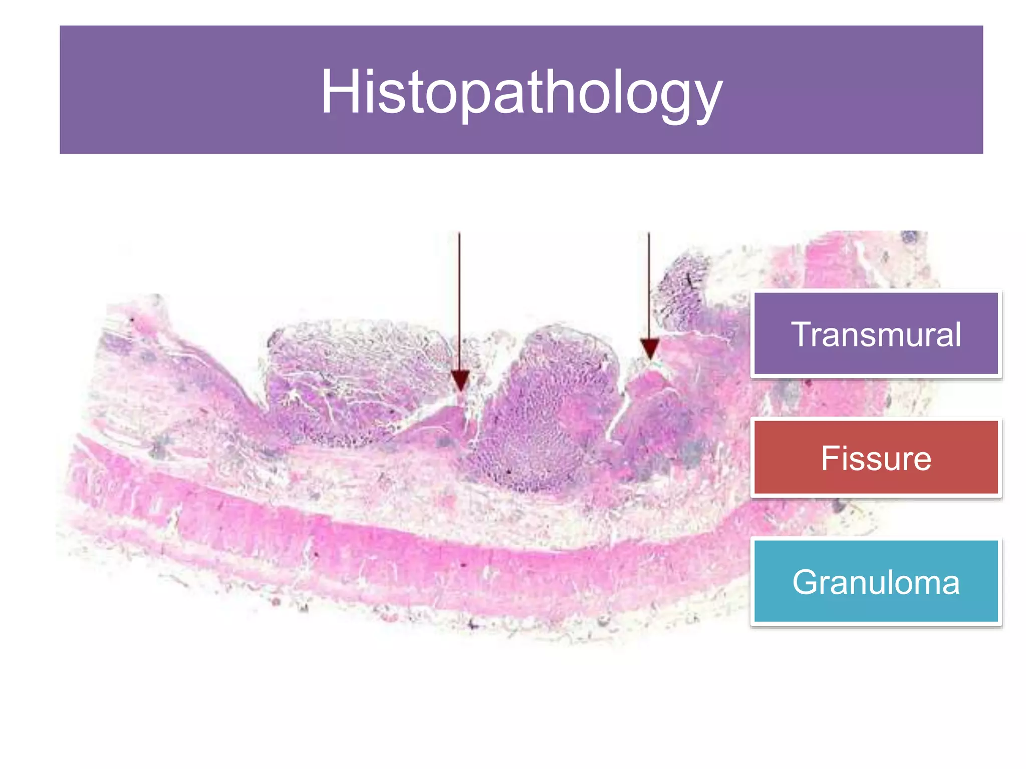 Ulcers of the intestine | PPTX