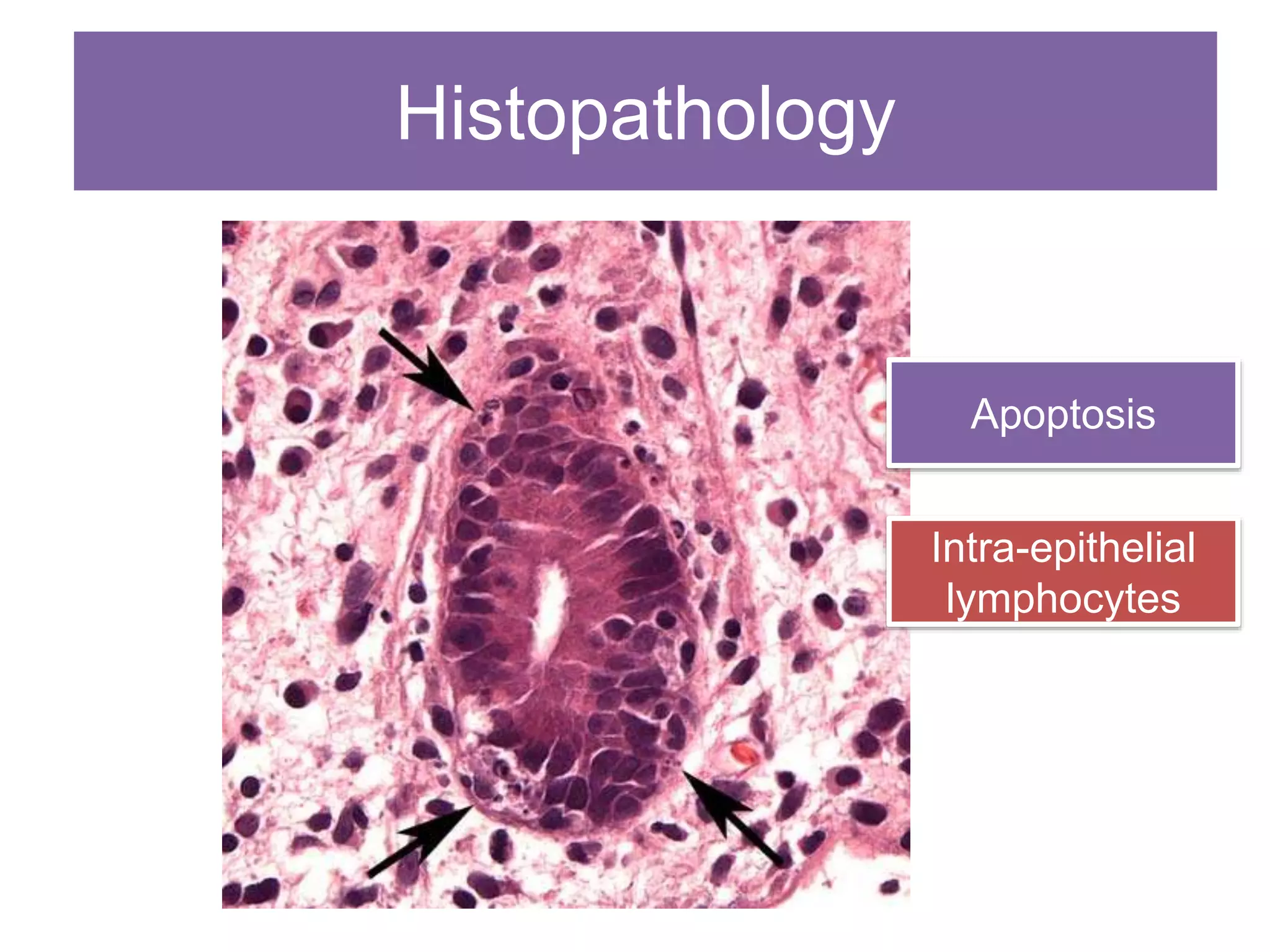 Ulcers of the intestine | PPTX