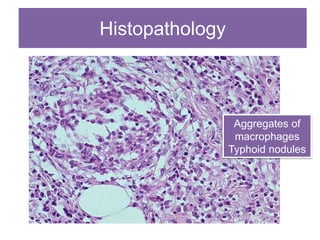 Ulcers of the intestine | PPTX
