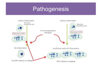 Ulcers of the intestine | PPTX
