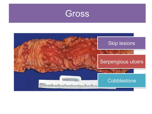 Ulcers of the intestine | PPTX