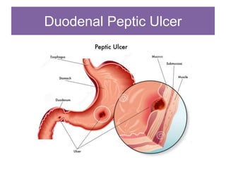 Ulcers of the intestine | PPTX