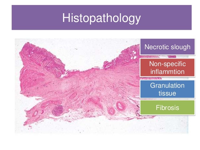 Skin Ulcer Histology