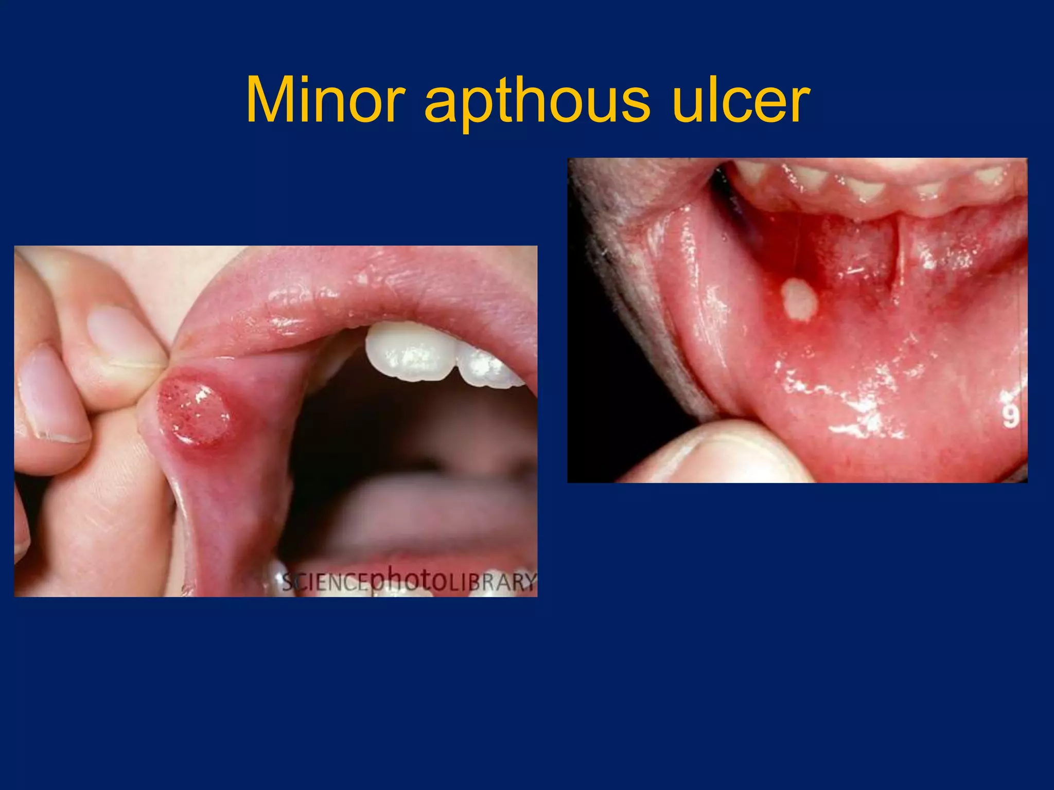 Ulcers of the oral Cavity Arshad.pptx