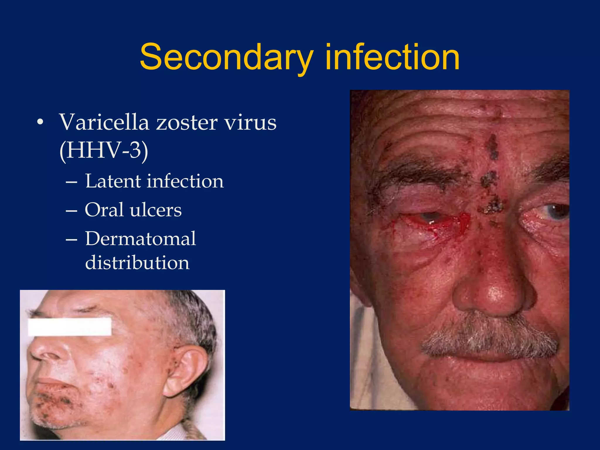 Ulcers of the oral Cavity Arshad.pptx