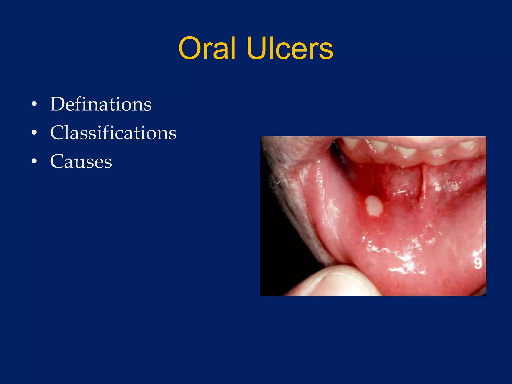 Ulcers of the oral Cavity Arshad.pptx