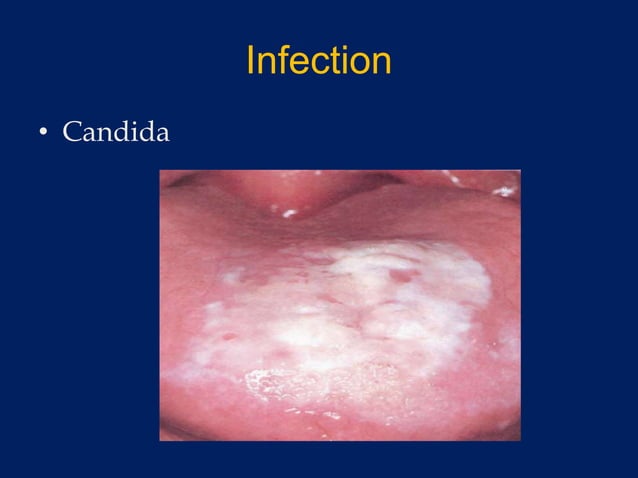 Ulcers of the oral Cavity Arshad.pptx | Ear, Nose and Throat Conditions ...