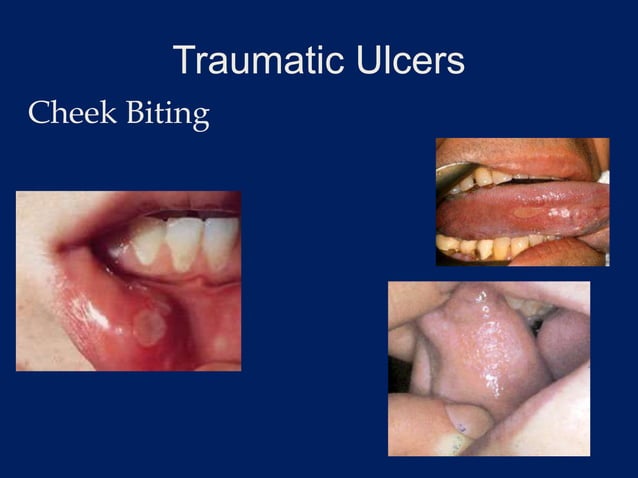 Ulcers of the oral Cavity Arshad.pptx
