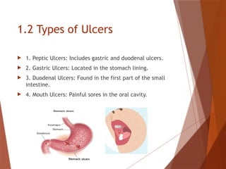 Ulcers_Presentation (2).pptx pharmacology | PPTX