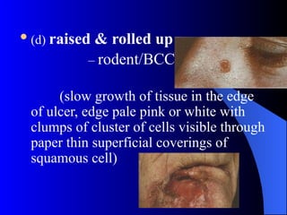 ULCERS, SINUSES & FISTULAE in surgical patients.ppt