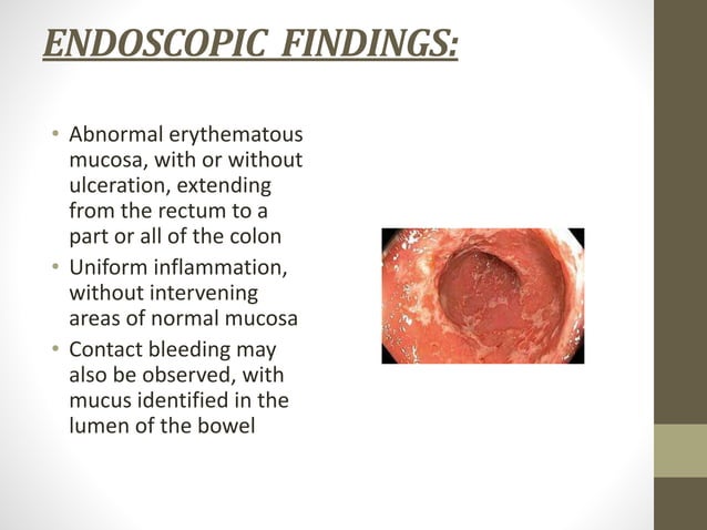 Ulcertative colitis | PPT