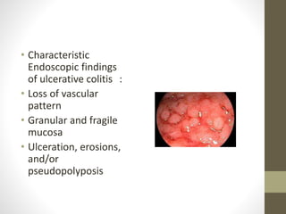 Ulcertative colitis | PPT