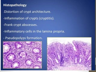Ulcertative colitis | PPT