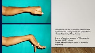 UpperLimbcerebralpalsy management protocol.pptx