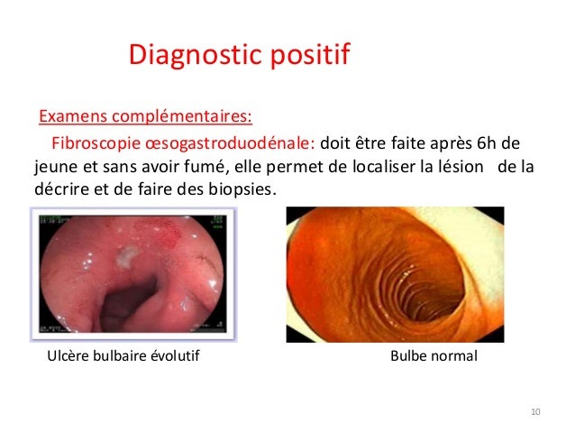 Ulcأ¨res gastro duodأ©naux