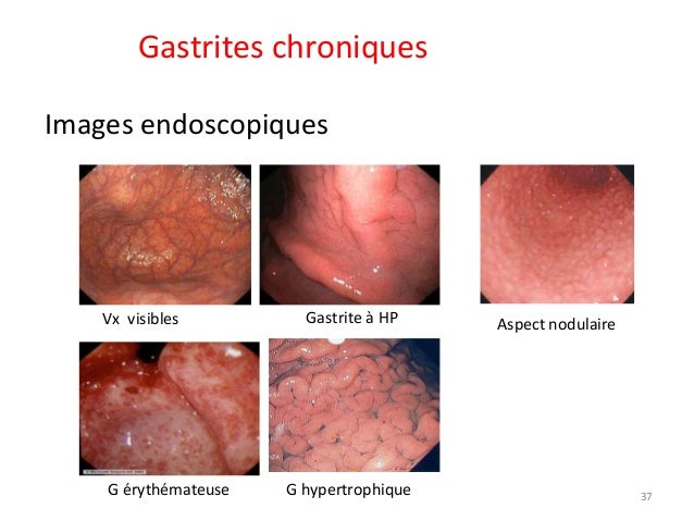 Ulcأ¨res gastro duodأ©naux