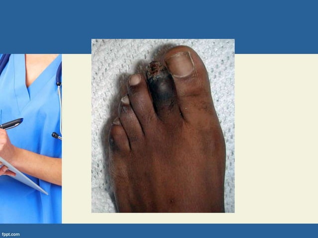 Ulkus diabetikum | PPT