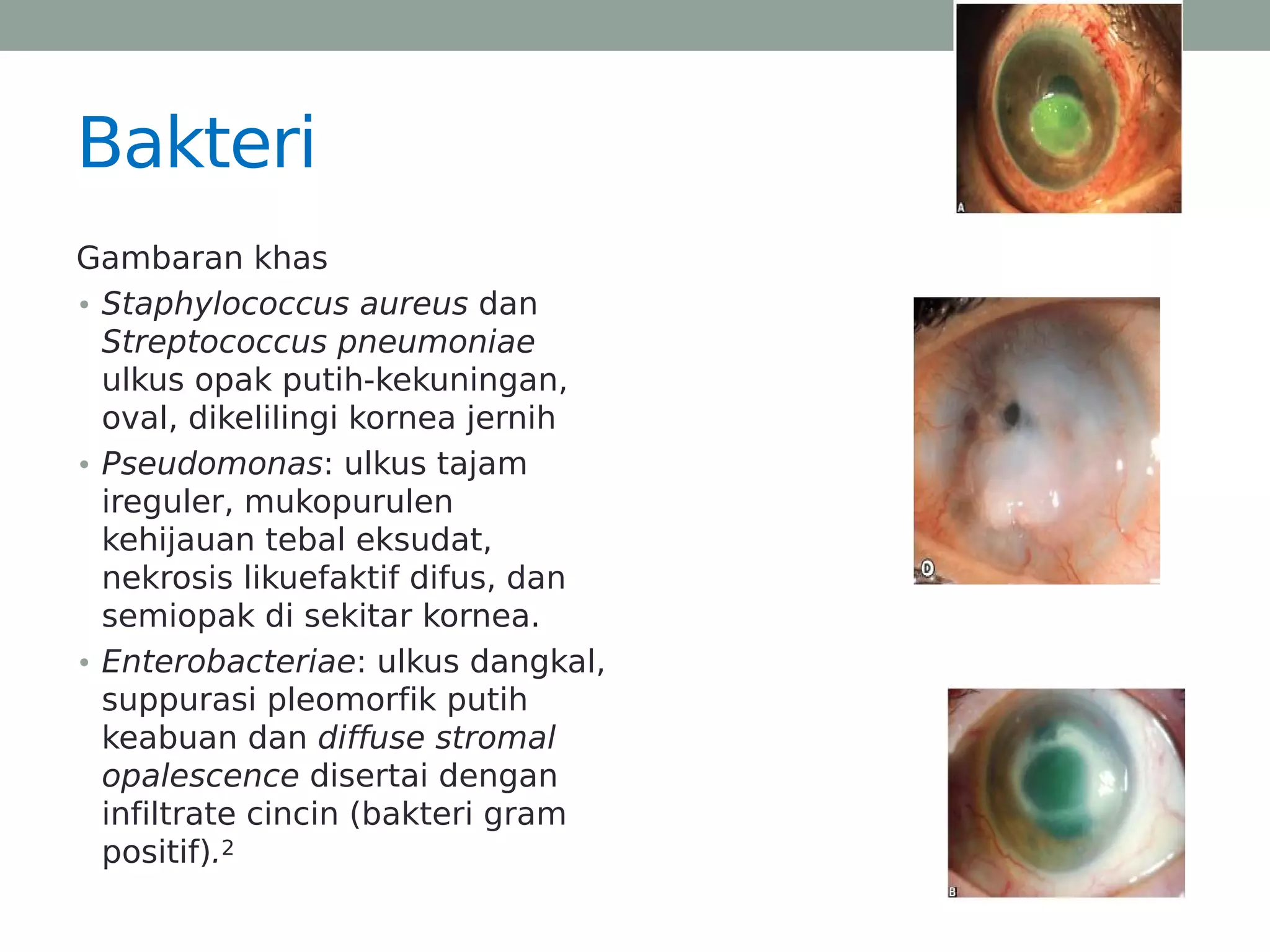 Ulkus kornea | PDF