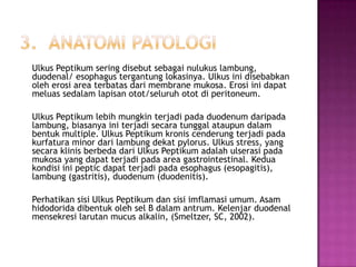 Ulkus peptik | PPTX