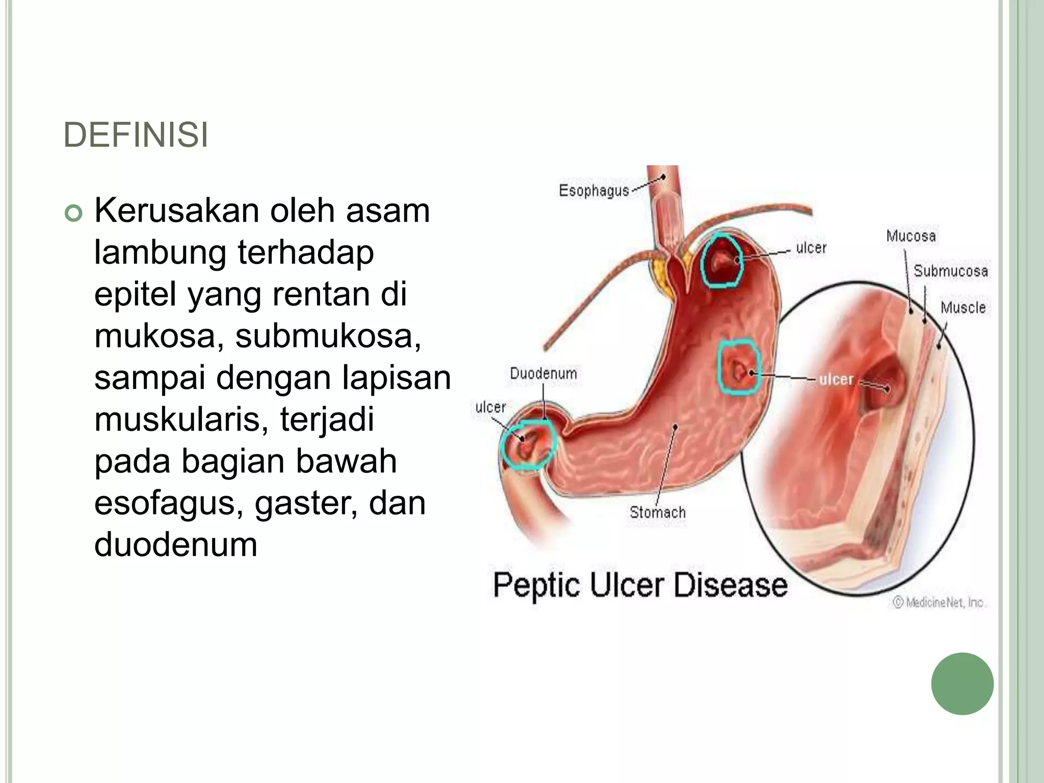Ulkus peptikum | PPTX