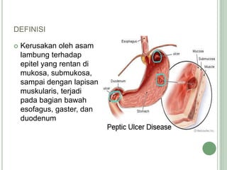 Ulkus peptikum | PPTX
