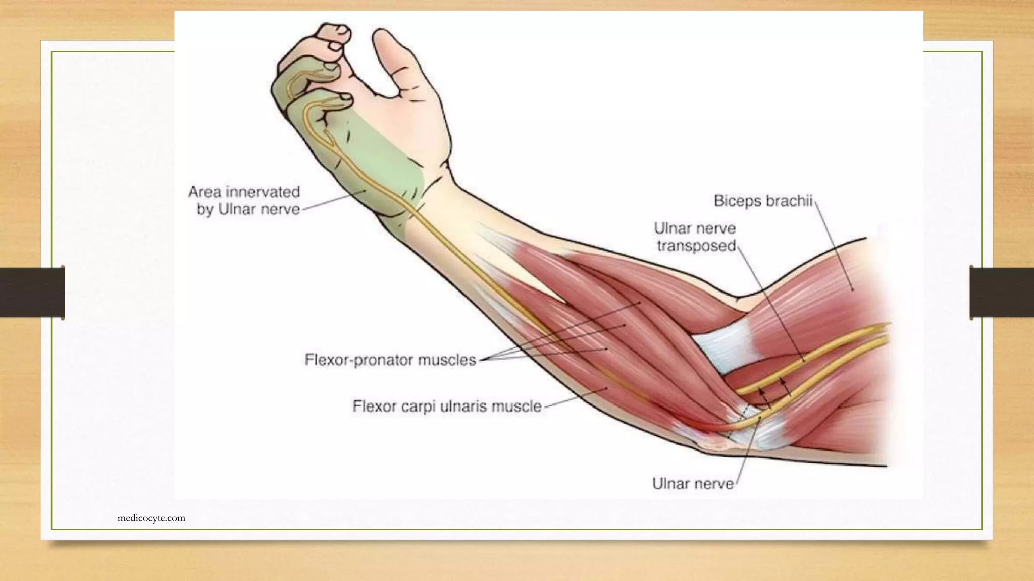Ulnar claw and ulnar paradox by medicocyte.com