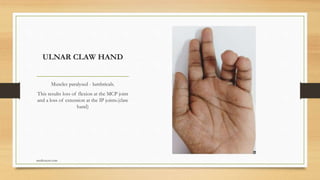 Ulnar claw and ulnar paradox by medicocyte.com
