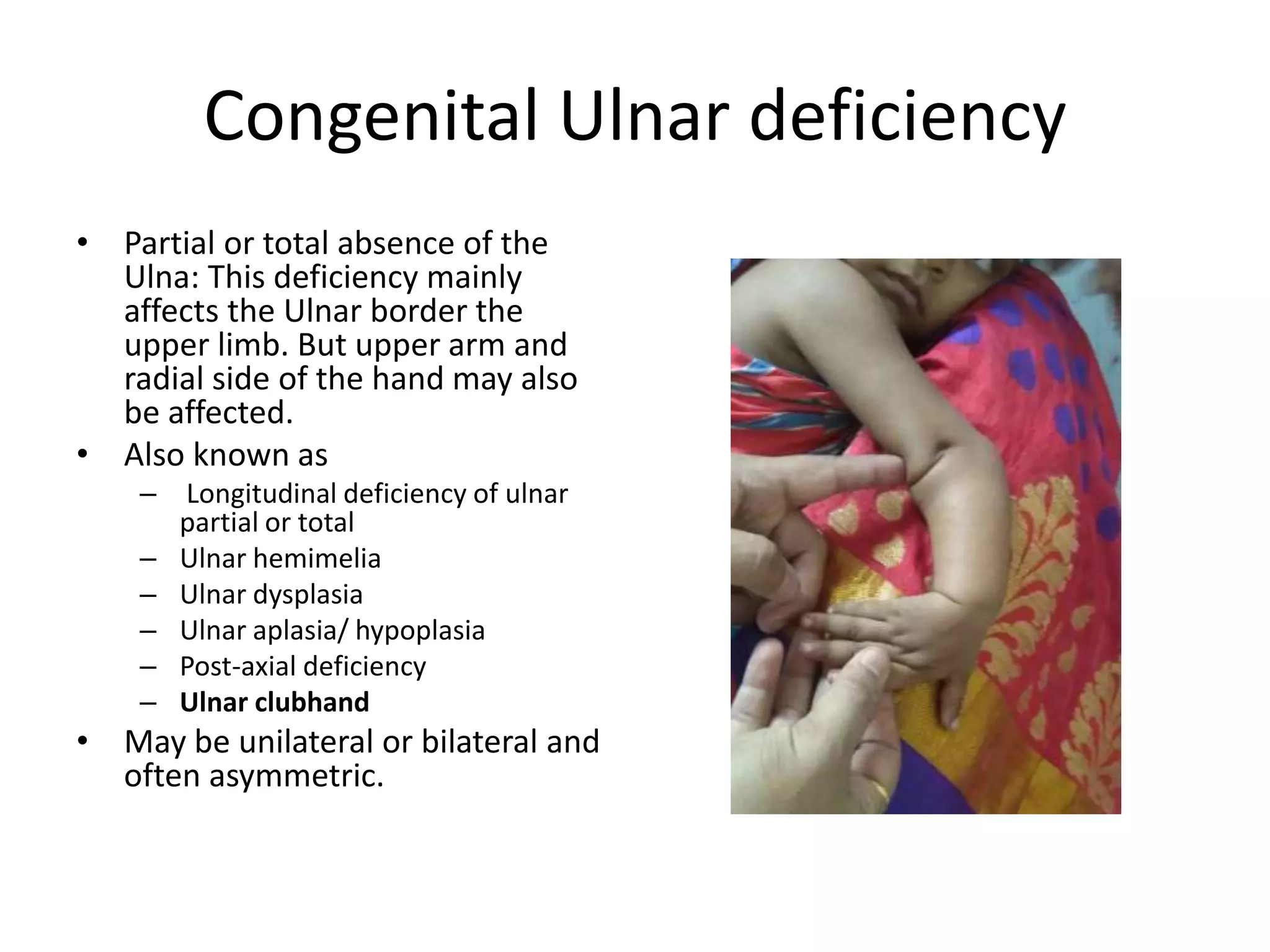 Ulnar Deficiency and Management.pptx