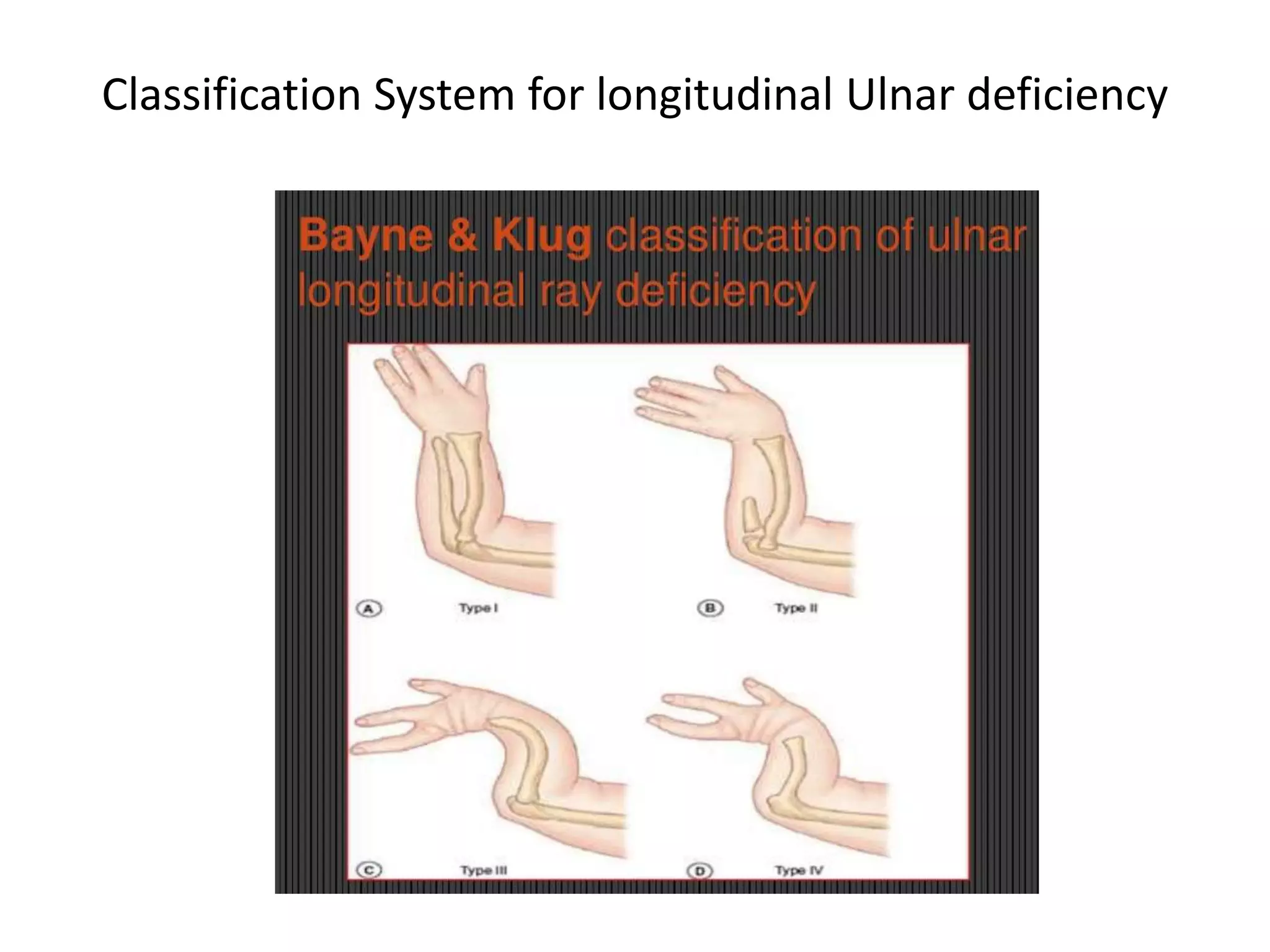 Ulnar Deficiency and Management.pptx