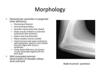 Ulnar Deficiency and Management.pptx