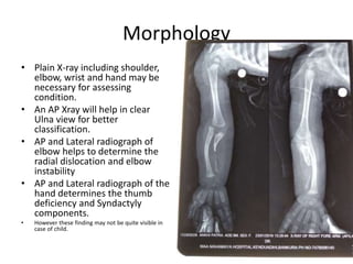 Ulnar Deficiency and Management.pptx