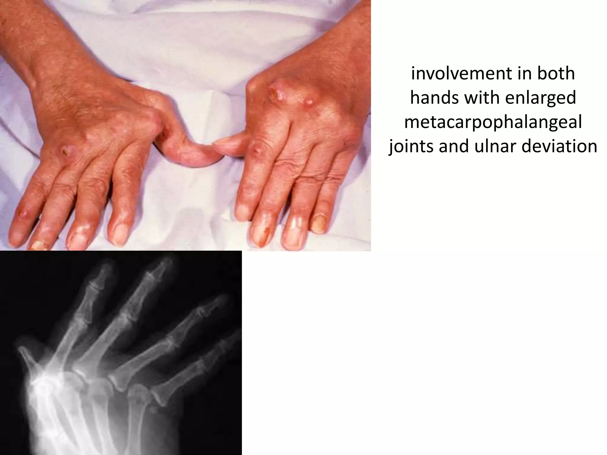 Ulnar deviations | PPTX
