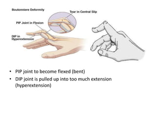 Ulnar deviations | PPT